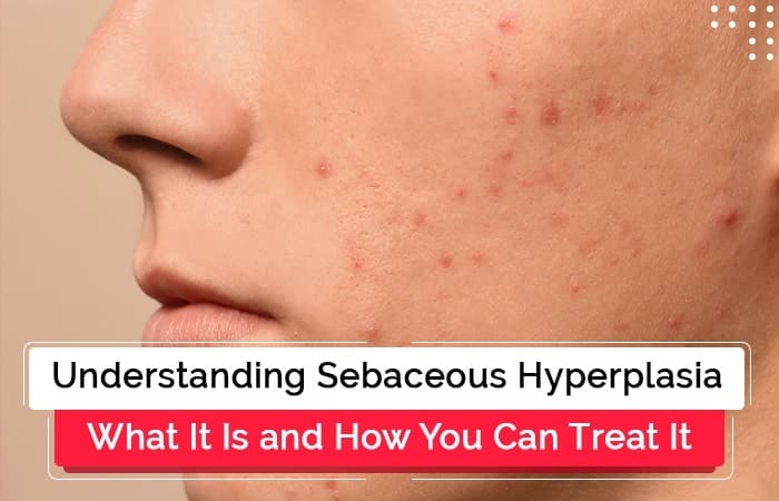 Understanding Sebaceous Hyperplasia What It Is And How You Can Treat