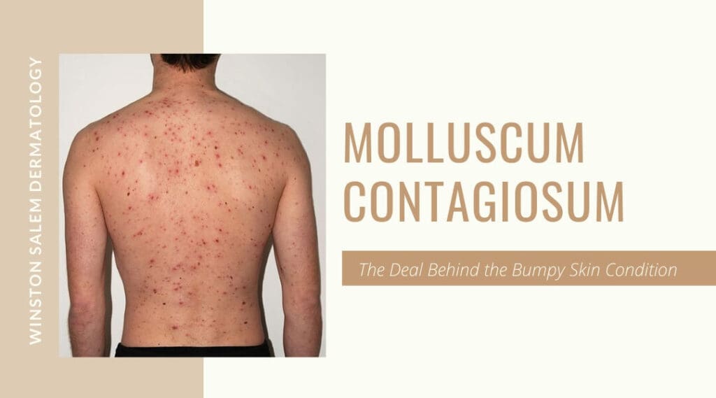 Molluscum Contagiosum, The Deal Behind Raising Bumps on Skin